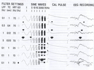 Eeg machine filters | PPT