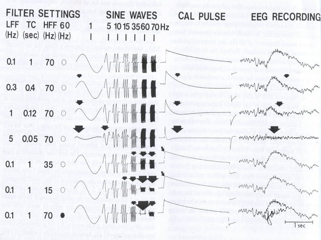 Eeg machine filters | PPT | Digital Audio | Computer Software and ...