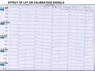 Eeg machine filters | PPT