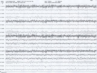 Eeg machine filters | PPT