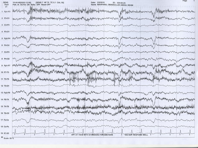 Eeg machine filters | PPT | Digital Audio | Computer Software and ...