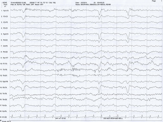 Eeg machine filters | PPT | Digital Audio | Computer Software and ...