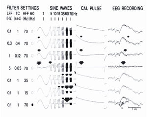 Eeg machine filters | PPT