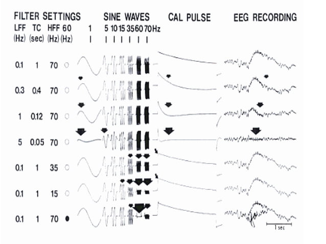 Eeg machine filters | PPT | Digital Audio | Computer Software and ...