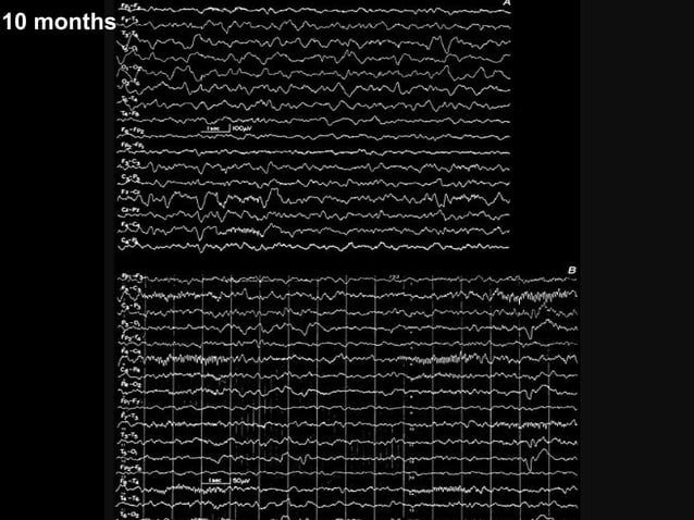 EEG Maturation - Serial evolution of changes from Birth to Old Age ...