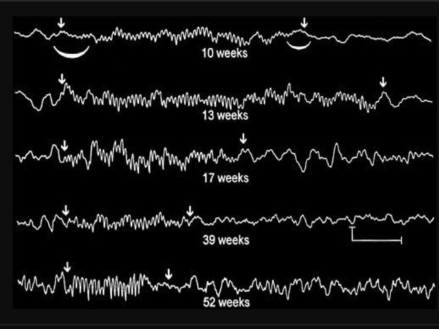 EEG Maturation - Serial evolution of changes from Birth to Old Age ...