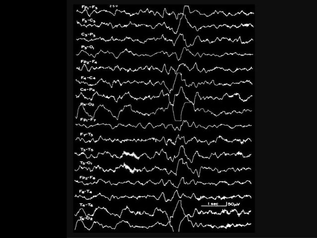EEG Maturation - Serial evolution of changes from Birth to Old Age ...