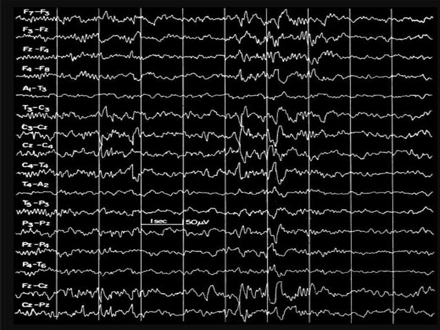 EEG Maturation - Serial evolution of changes from Birth to Old Age ...