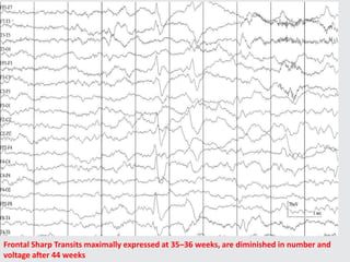 Eeg maturation | PPTX
