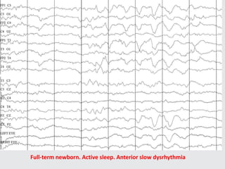 Eeg maturation | PPTX