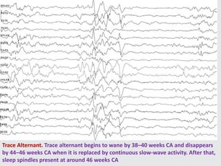Eeg maturation | PPTX