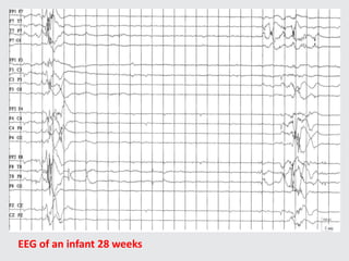 Eeg maturation | PPTX