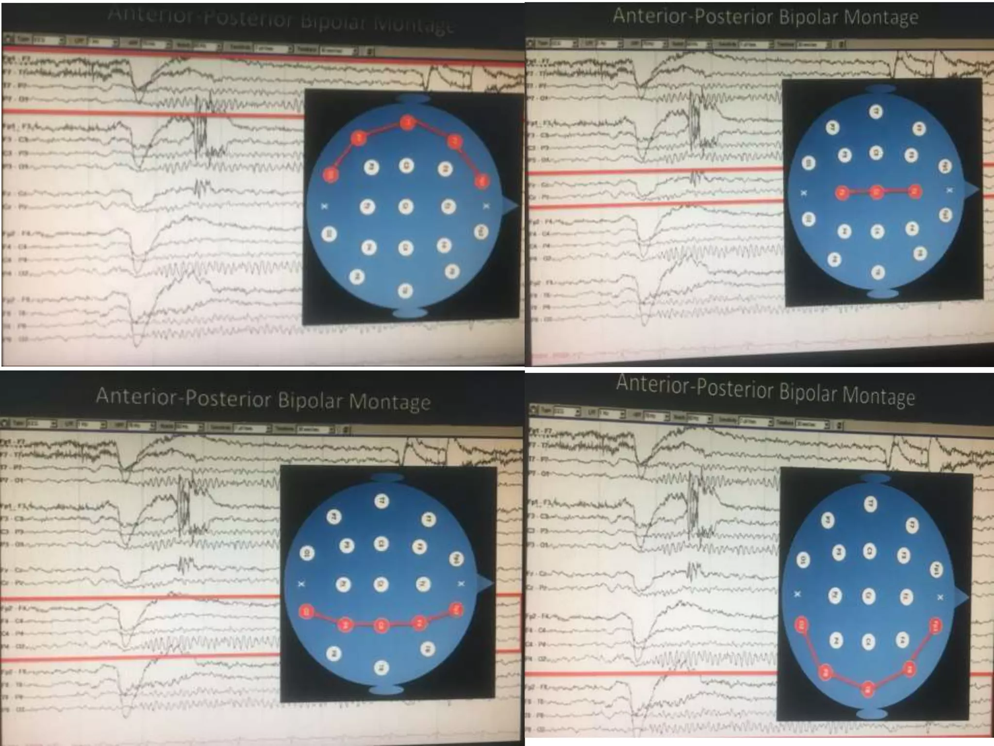 EEG INTERPRETATION | PPTX