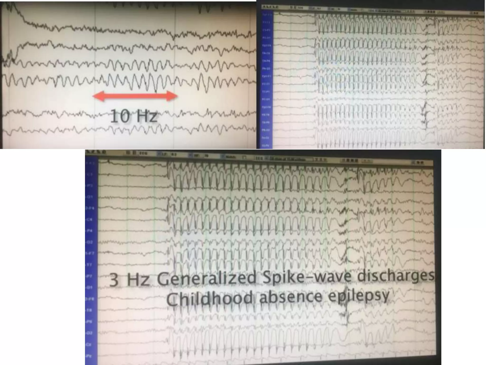 EEG INTERPRETATION | PPTX