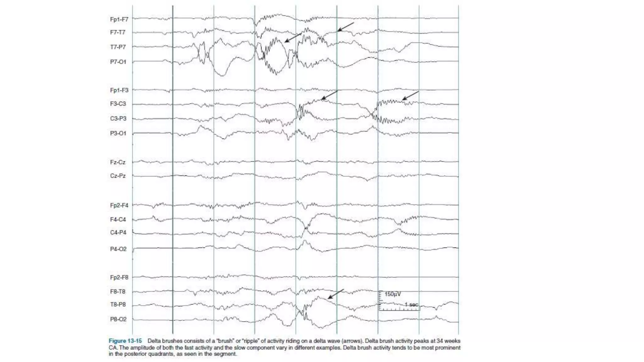 eeg of newborn.pptx
