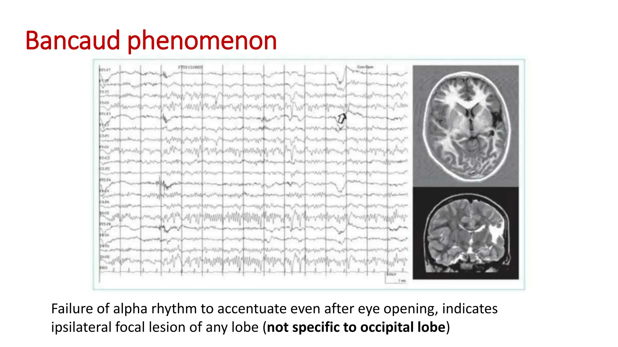 eeg ppt defining all aspects of eeg and various type of waves seen in ...