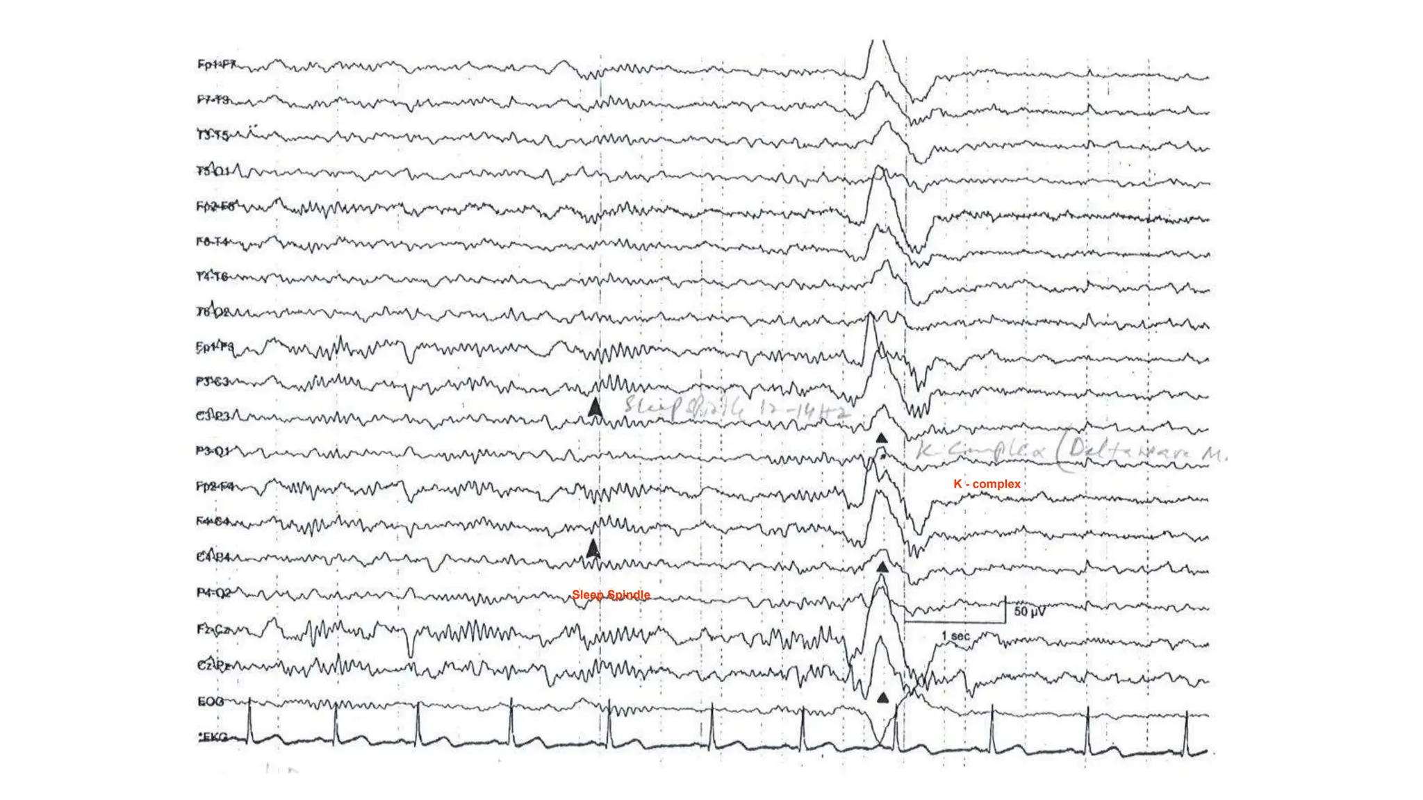 eeg ppt defining all aspects of eeg and various type of waves seen in ...