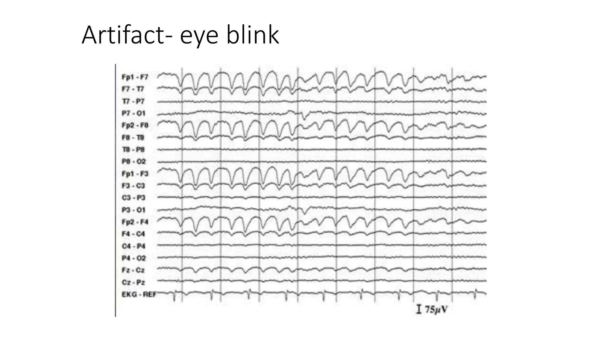 eeg ppt defining all aspects of eeg and various type of waves seen in ...