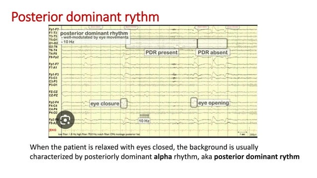 eeg ppt defining all aspects of eeg and various type of waves seen in ...