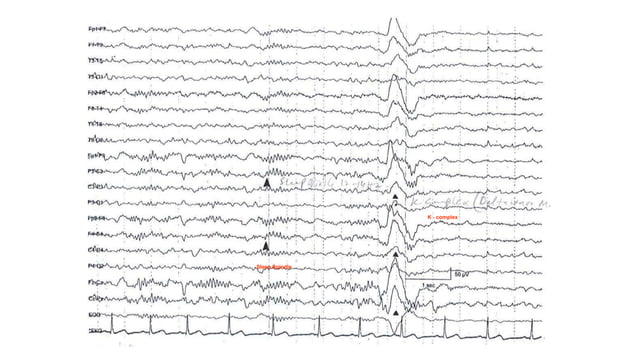 eeg ppt defining all aspects of eeg and various type of waves seen in ...