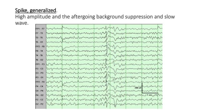 eeg ppt defining all aspects of eeg and various type of waves seen in ...