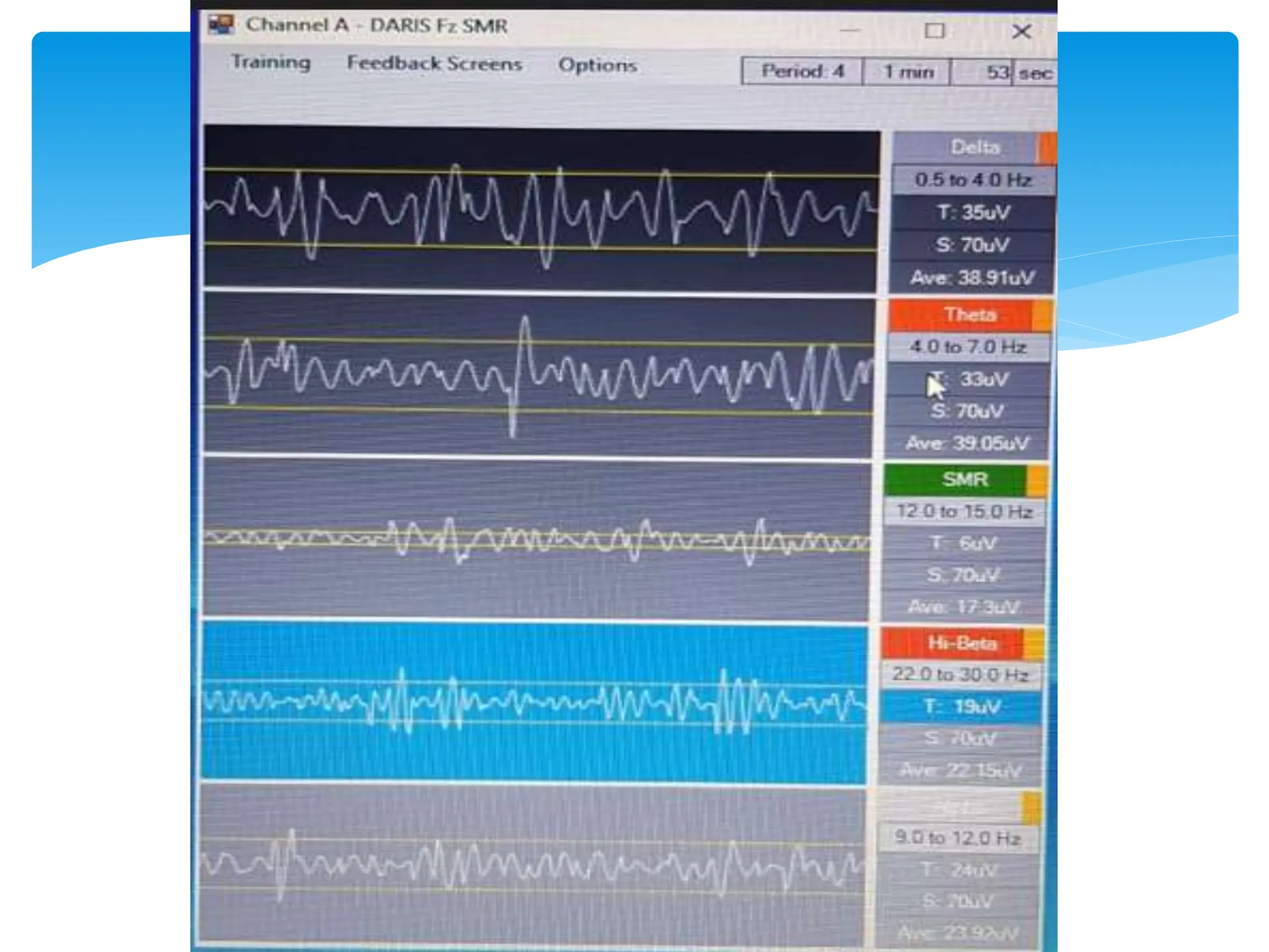 EEG signal processing and application to Neurofeedback : Operant ...