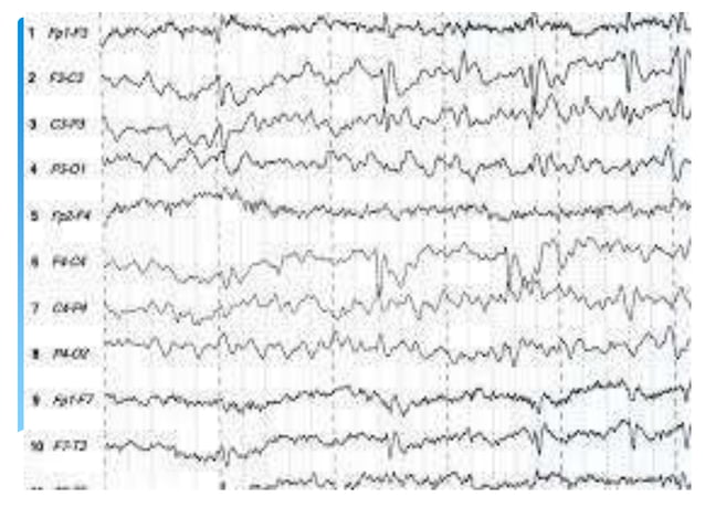EEG signal processing and application to Neurofeedback : Operant ...