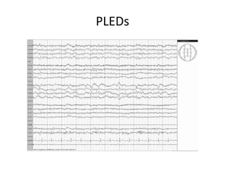 eeg y enfermedad cerebrovascular 2 pc.pptx