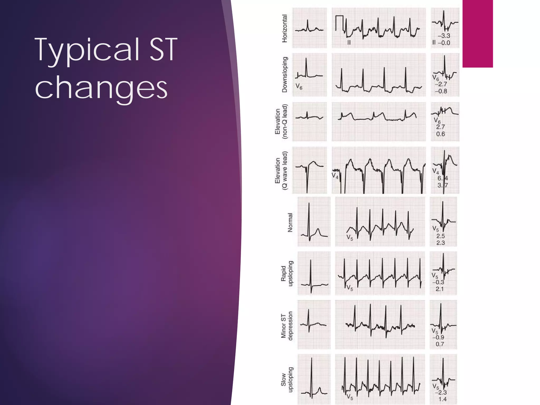 Exercise Electrocardiographic testing | PDF