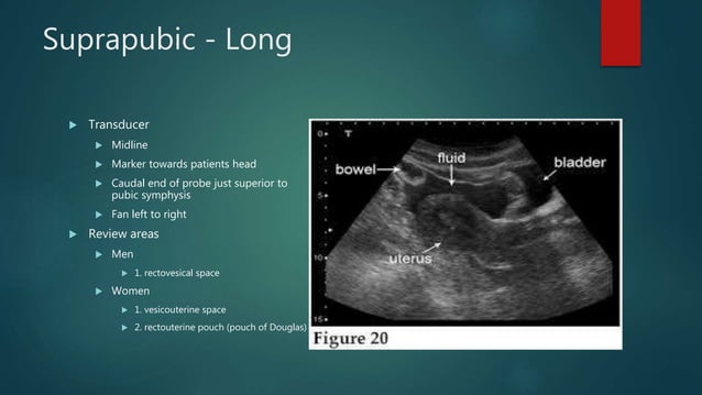 E-Fast Examination | PPTX | Lung and Respiratory Health | Diseases and ...