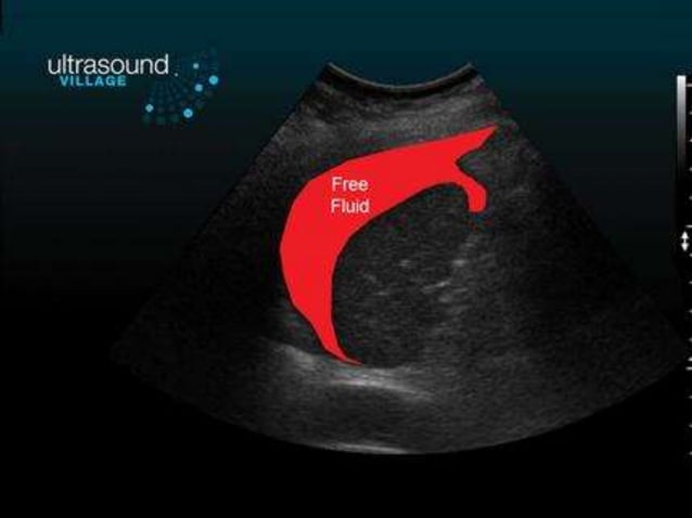 EFAST - A how to guide | PPTX | First Aid | Injuries