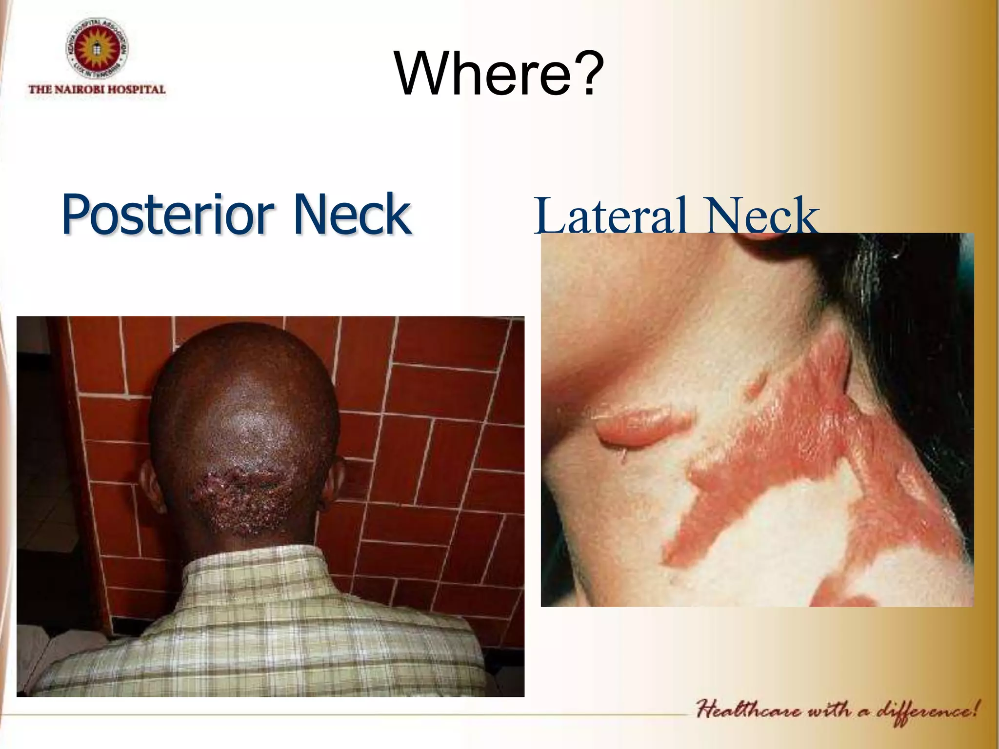 Keloids | PPTX