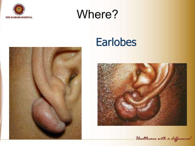 Keloids | PPTX | Skin and Dermatology | Diseases and Conditions