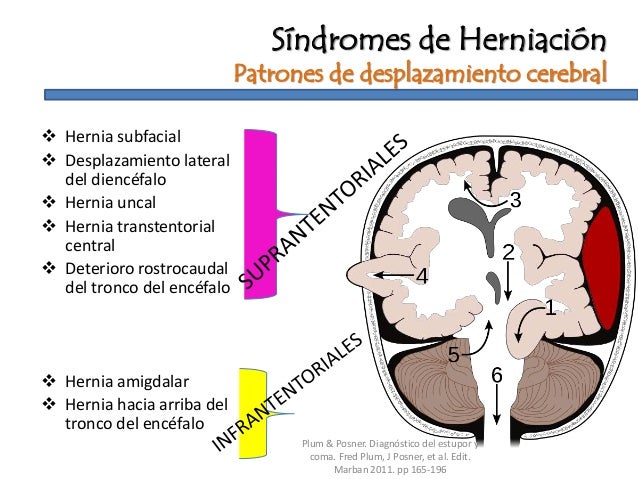 Sìndromes de herniaciòn cerebral