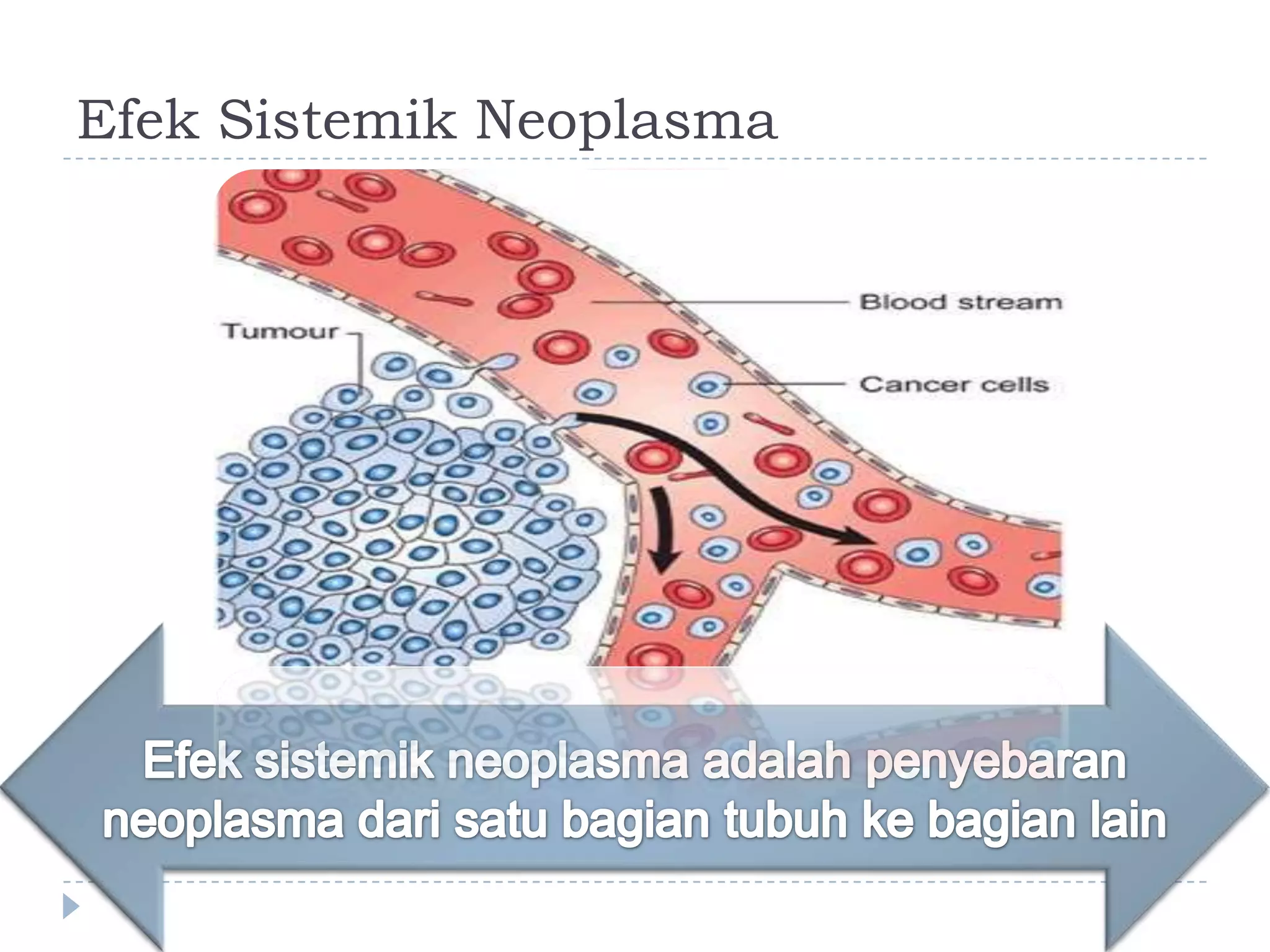 Efek Sistemik Neoplasma | PPTX