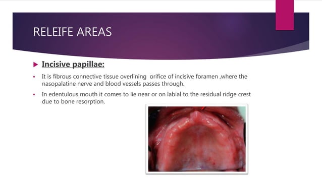 Anatomical landmarks of edentulous maxillary arch | PPT