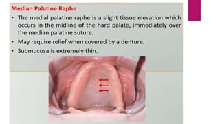 Anatomical landmarks of edentulous maxillary arch | PPTX