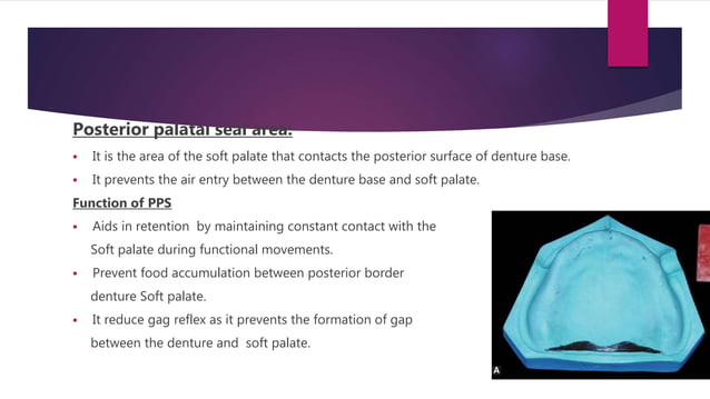 Anatomical landmarks of edentulous maxillary arch | PPT