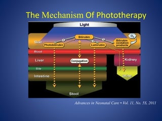 Effective phototherapy for neonatal jaundice | PPTX