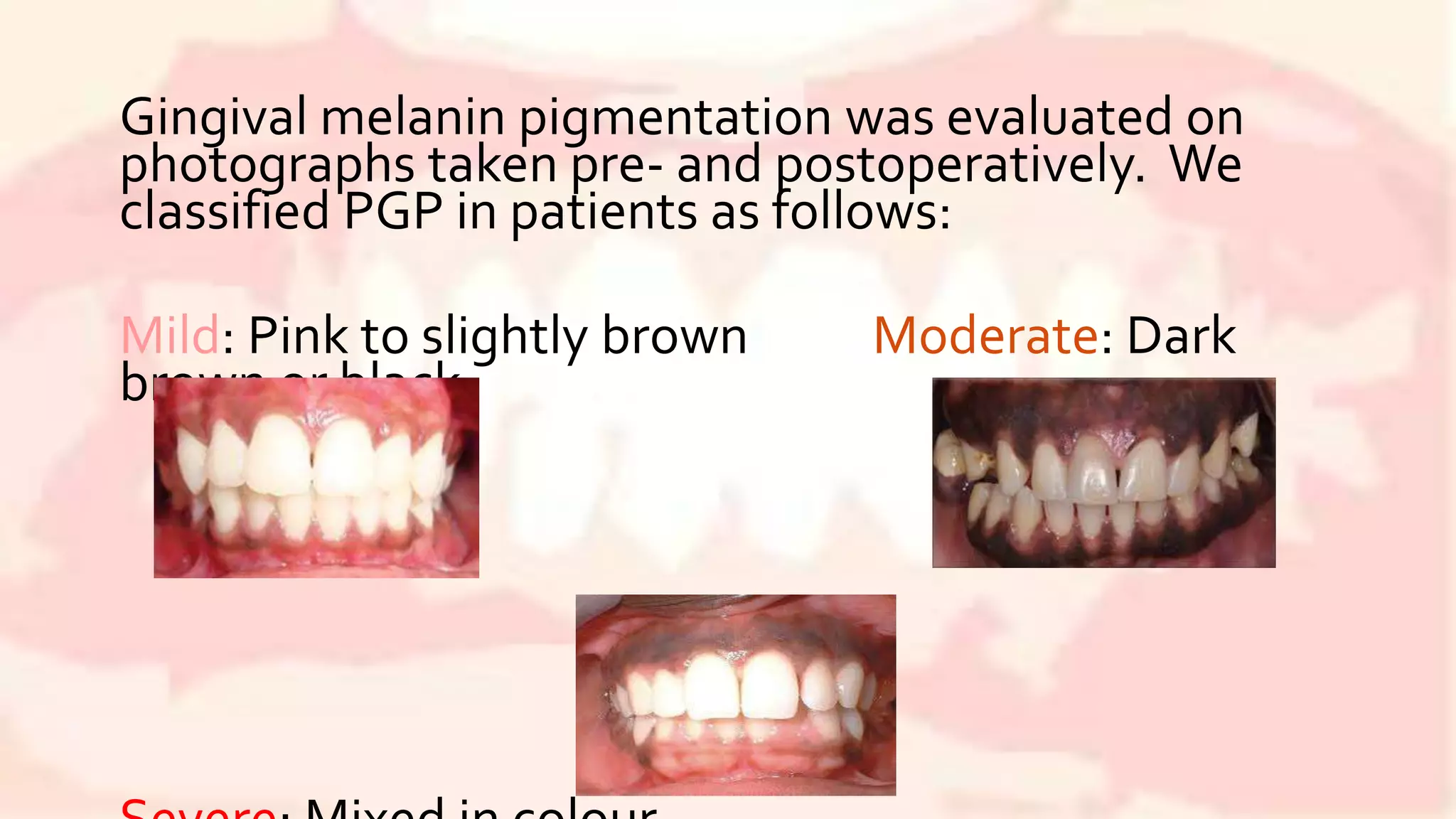 Effect of diode laser depigmentation of gingival tissues | PPTX