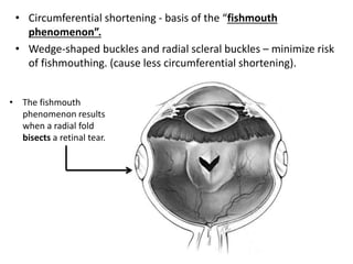Effect of scleral buckle on geometry of eye.pptx
