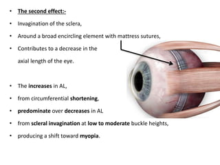 Effect of scleral buckle on geometry of eye.pptx