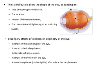 Effect of scleral buckle on geometry of eye.pptx
