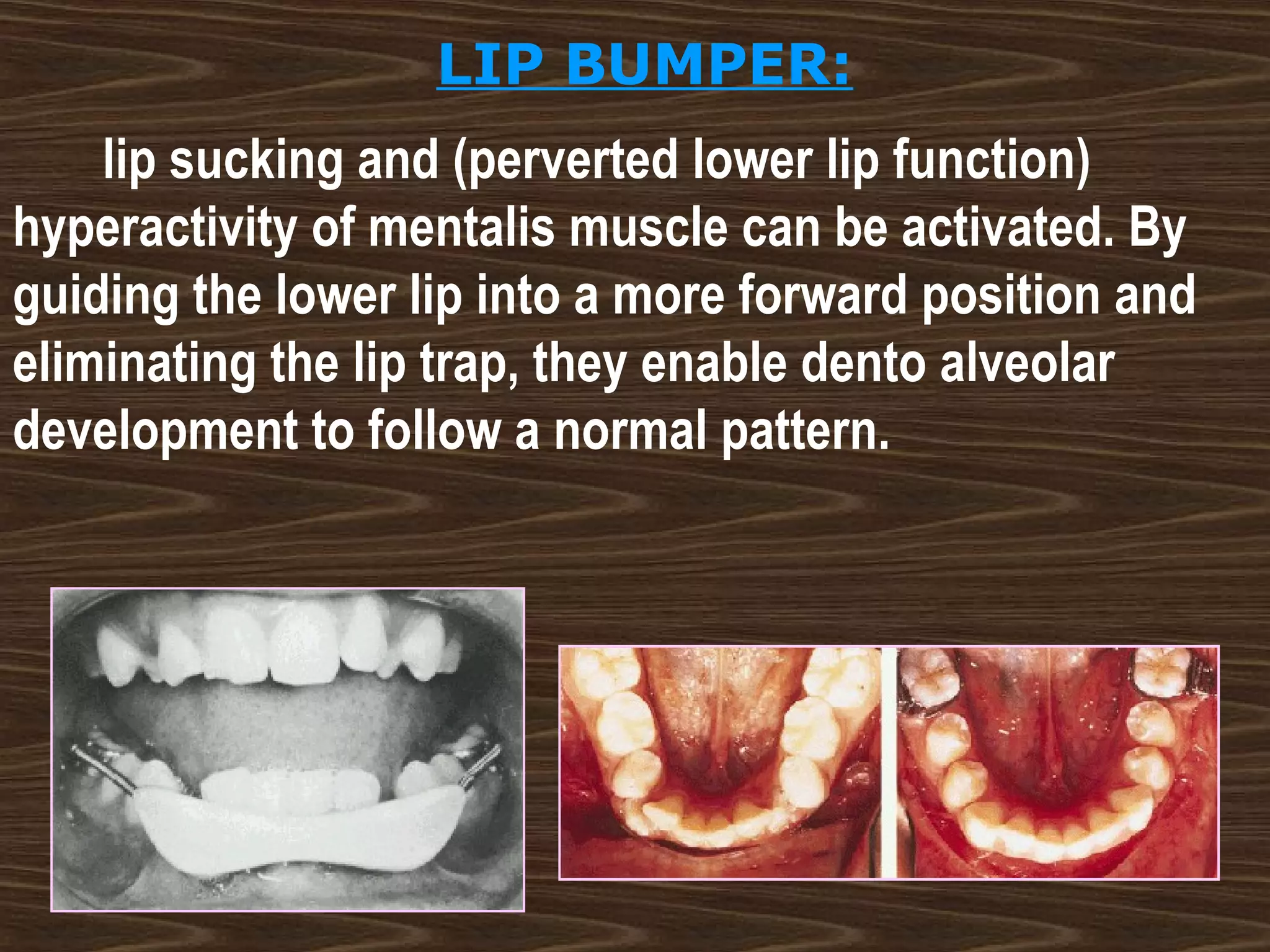 Effects and effects of functional appliances | PPT