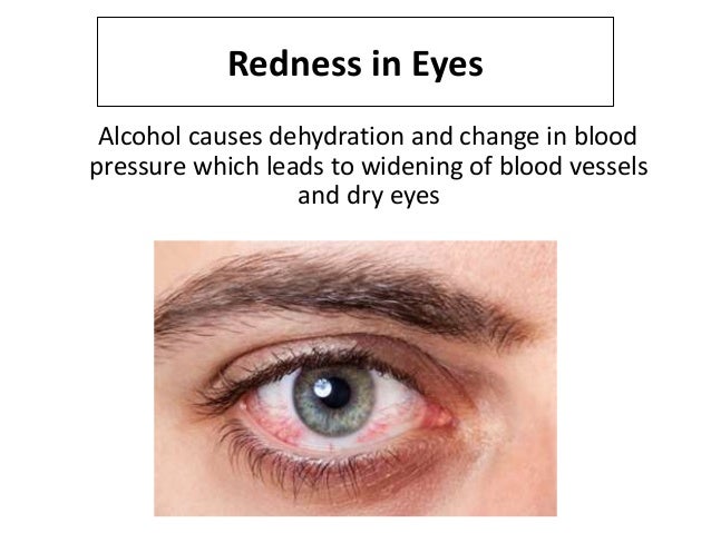 Effects of Alcohol on Eyes