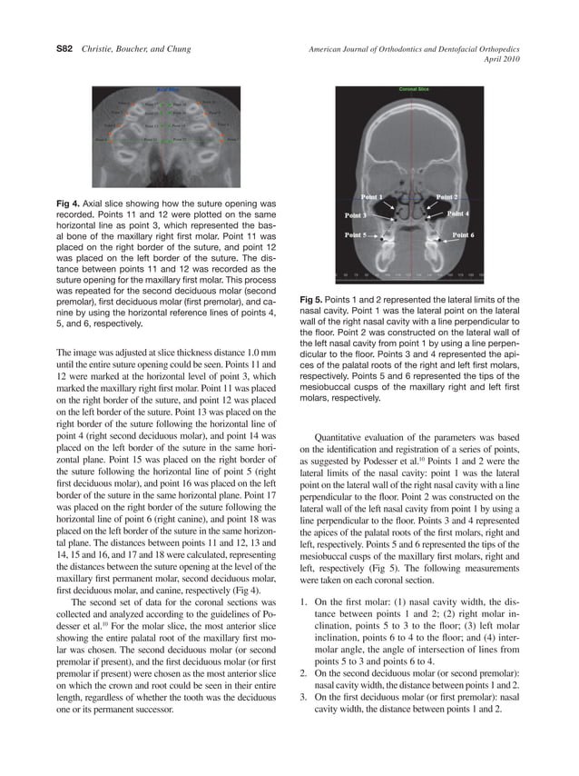 Effects of bonded rapid palatal expansion on the transverse dimensions ...