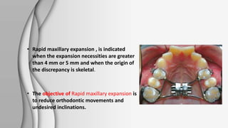 Effects of Disjunction Rapid maxillary expansion.pptx