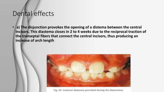 Effects of Disjunction Rapid maxillary expansion.pptx