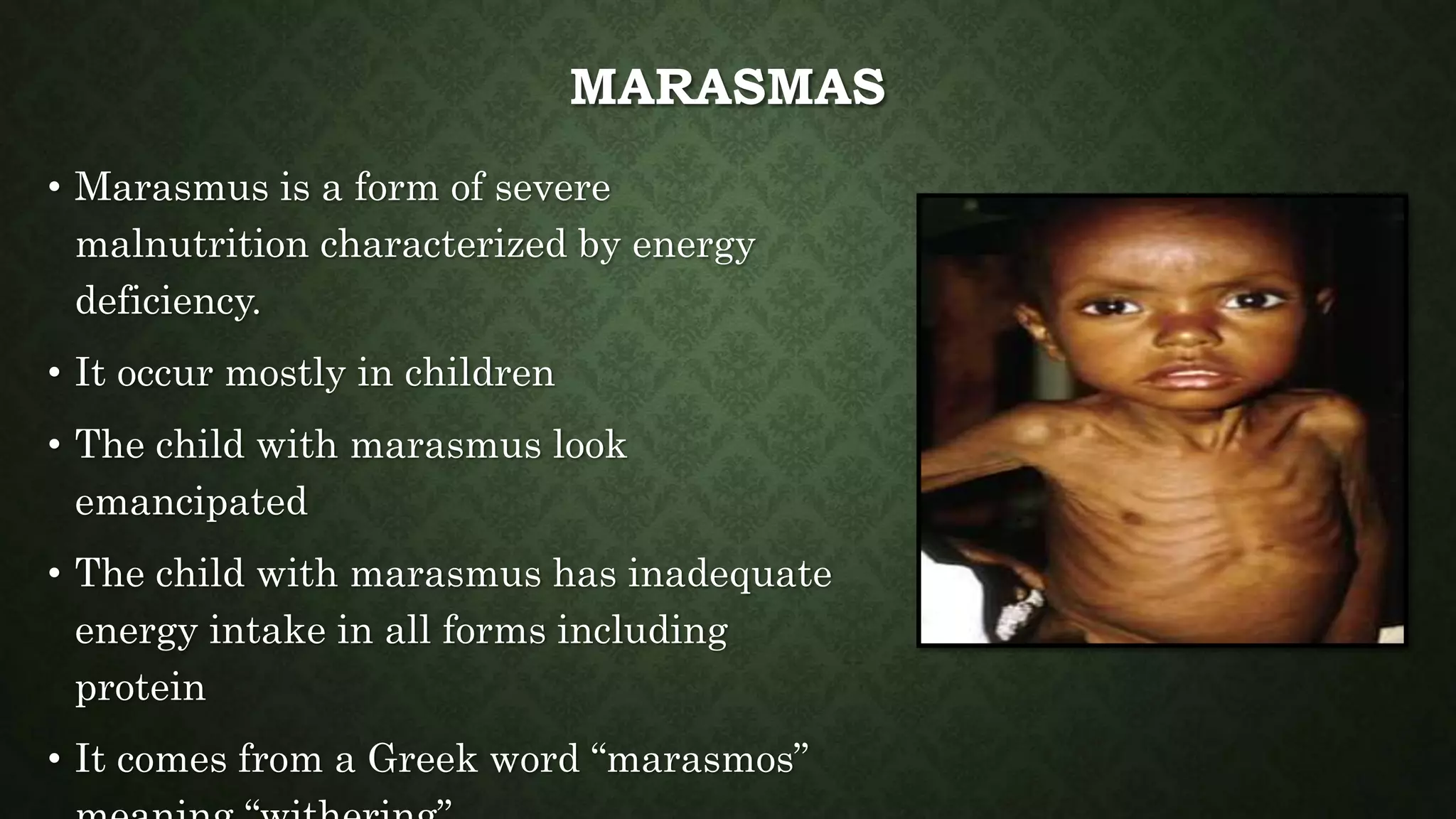 Effects of malnutrition in children | PPTX