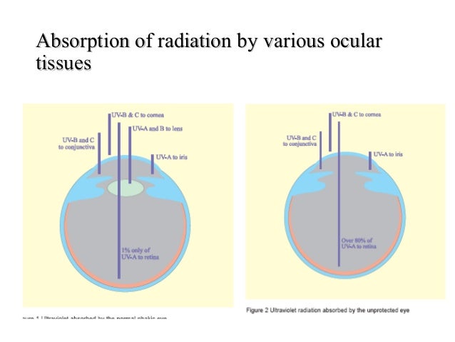 Effects of radiation and glare in eye